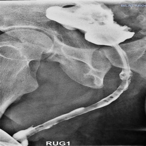 Urethral Duplication Urinary Division Download Scientific Diagram