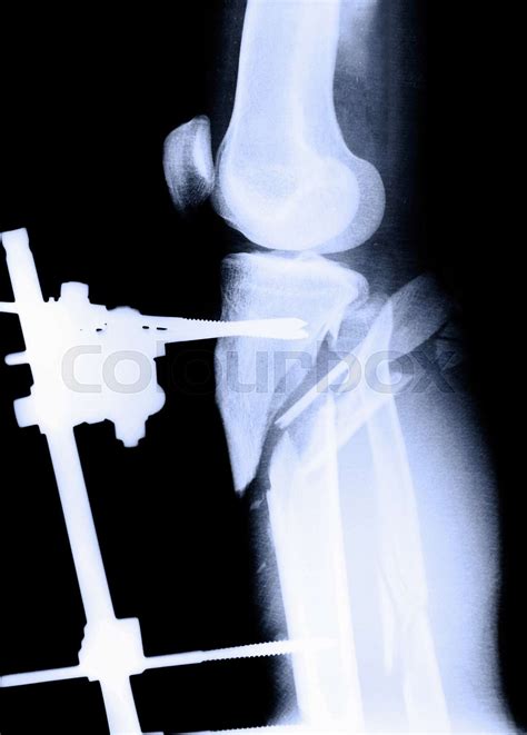Film X Ray Leg Bone Fracture Stock Image Colourbox