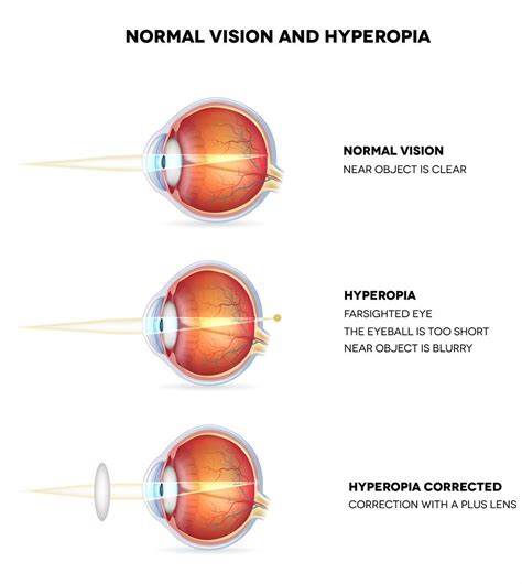Hyperopia Innovative Eye Care