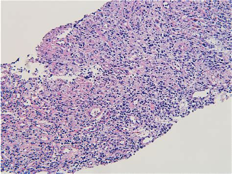 Axillary Lymph Node Biopsy Demonstrating Necrotizing Lymphadenitis Hande Download Scientific