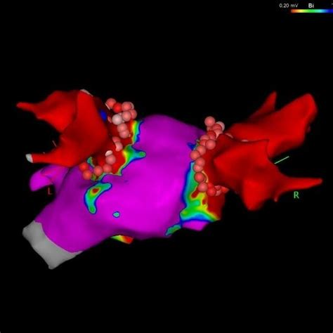 Posterior Left Atrium With Normal Voltage Noted After Successful