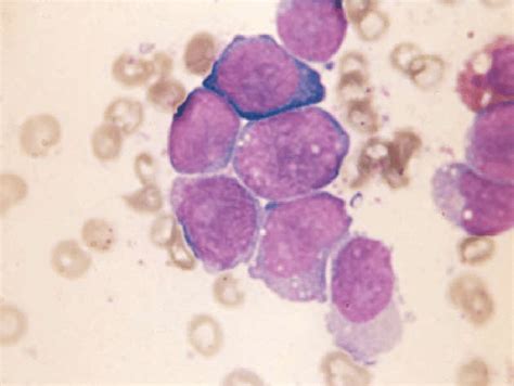 Diagnosis Aml M4 Leukaemia Cutis Download Scientific Diagram