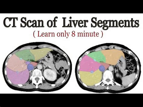 Ct Scan Of Liver Segments Anatomy Youtube