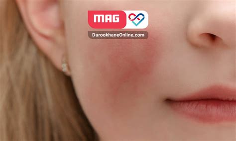 بیماری پنجم اریتم عفونی در کودکان چیست؟