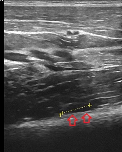 Ultrasound Guided Prp Injection International Acp Center