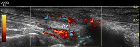 Cppd Arthritis Stt Peritendinous Inflammation Fcr Ganglion Cyst