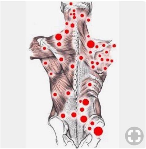 Pin By Helun Ford On Fibromyalgia Fibromyalgia Trigger Points Trigger Points Fibromyalgia