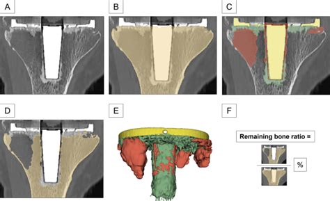 Tibial Bone Defect Prediction Based On Preoperative Artefact Reduced Ct