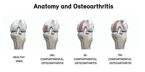 Guide To Severe Knee Arthritis Tricompartmental 54 Off