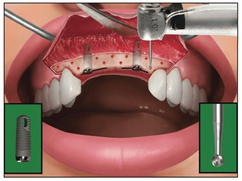 Ridge Expansion Osteotomy A Combination Technique Dentistry Today