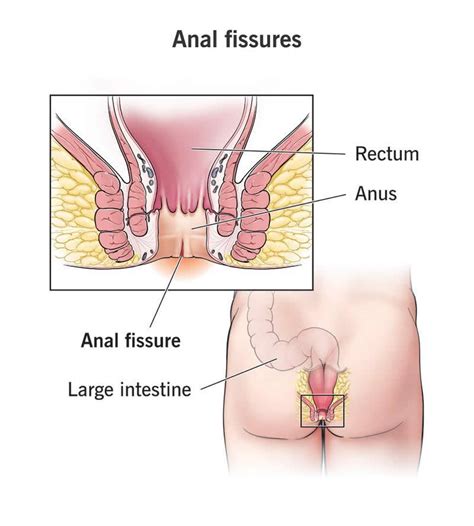 Anal Fissure What It Is Symptoms Causes And Treatment Wockr