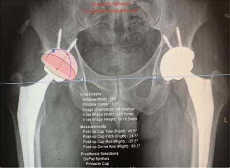 The Method Of Measuring Anteversion And Inclination Of Acetabular Cups Download Scientific
