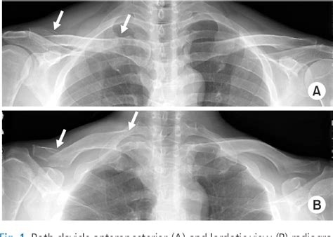 Figure 1 From The Different Treatment Methods For Segmental Fractures Of The Clavicle Cases