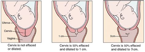 3cm Dilated Cervix