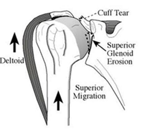 Indiaorthosurgeon Cuff Tear Arthropathy