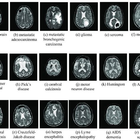 Sample Of Brain Mris Download Scientific Diagram