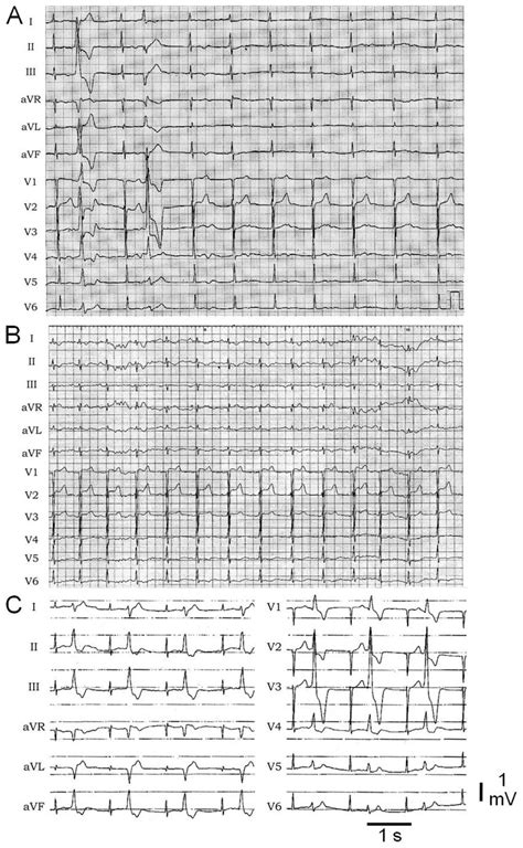 Electrocardiograms Of The Patient Twelve Lead ECG Showing Prolonged QT Download Scientific