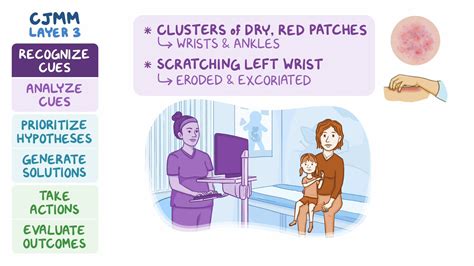 Case Study Pediatric Eczema Nursing Osmosis Video Library