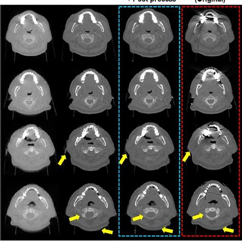 A Proposed Mar In Kv Ct Images Throughout Two Step Sequential Network Download Scientific