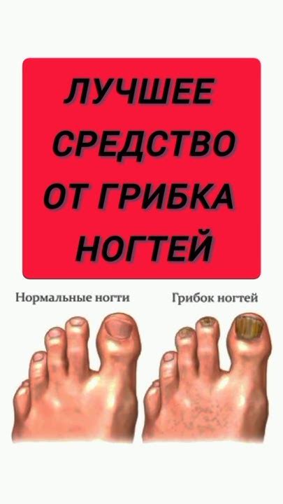 Лучшее средство от грибка ногтей Youtube