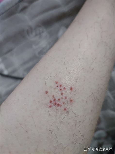 小腿上外侧大红点20个 知乎 小腿上外侧大红点20个 知乎