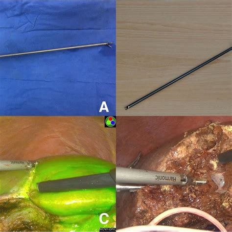 Some Critical Surgical Instruments Used In Laparoscopic Hemihepatectomy Download Scientific