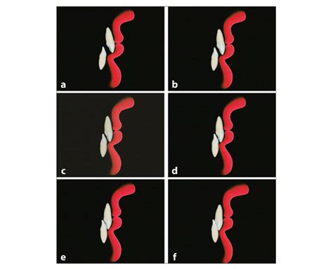 12 Class Ii Division 2 Malocclusions Pocket Dentistry