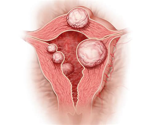 Fibroid Is Not Responsible For Infertility In All Cases Ajayi Tribune Online