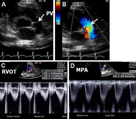 Neonatal Echo