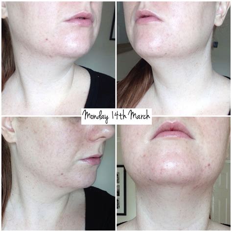 My Experience With Erythromycin For Acne Rachael Divers