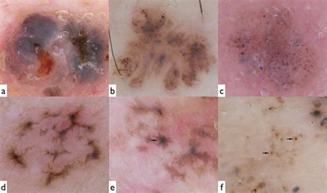 Bcc Dermoscopy Diagram Quizlet