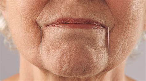 Marionette Lines Plastic Surgery At Brenda Bradley Blog