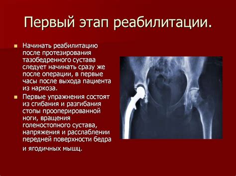 Рекомендации после эндопротезирования тазобедренного сустава: ФГБУ «СПб ...