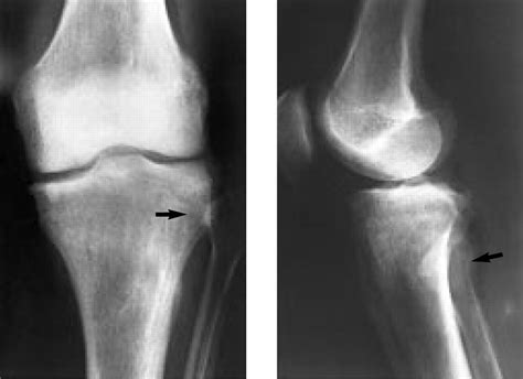 Proximal Tib Fib Dislocation Knee And Sports Orthobullets
