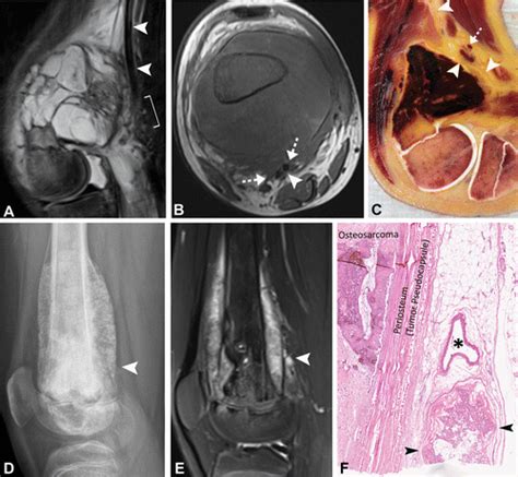 Osteosarcoma Knee Mri