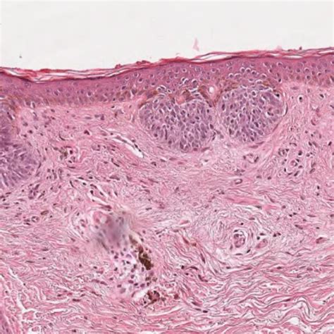 Micronodular Bcc Hande Stain X40 Basaloid Neoplasm With Small Nodules Download Scientific