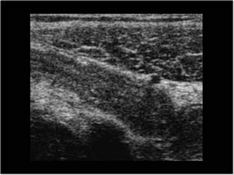 Abdomen And Retroperitoneum 15 Appendix Case 152 Uncomplicated Abdomen And Retroperitoneum 15 Appendix Case 152 Uncomplicated