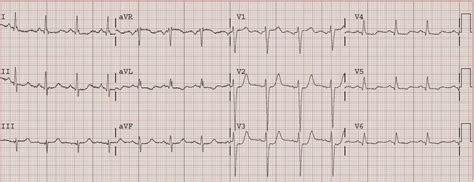 Pure Isolated Posterior Stemi Not So Rare But Often Ignored Dr