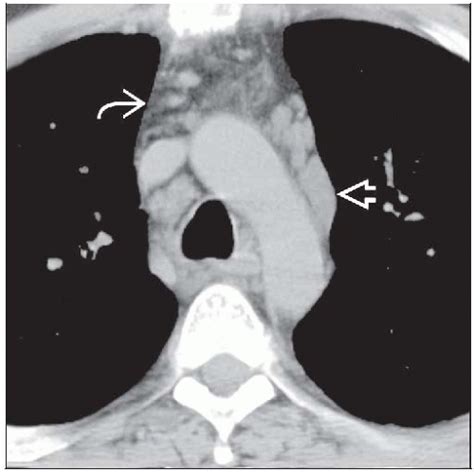 Diffuse Pulmonary Lymphangiomatosis Radiology Key