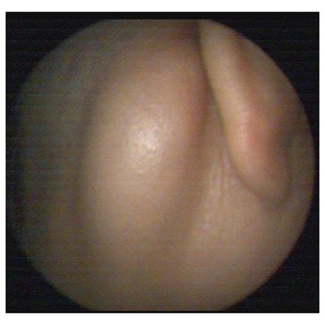 Right Postauricular Bulging Mass Which Is Asymptomatic Hard And Download Scientific Diagram