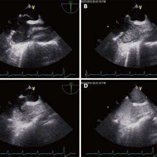Transesophageal Echocardiography With Bubble Study A Transesophageal Download Scientific