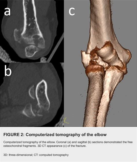 Distal Humerus Anatomy