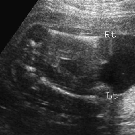 Axial Ultrasound Image Of A Female Fetus Shows The Right Femur