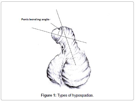 Quest Ce Que Lhypospadias Lhypospadias Symptômes Causes Et