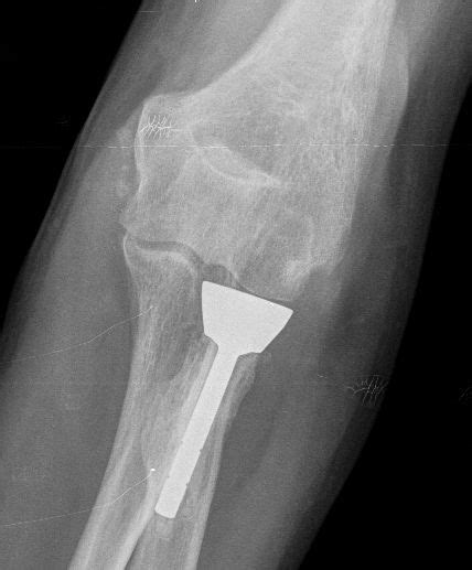 Фрактура на главата на лъчевата кост