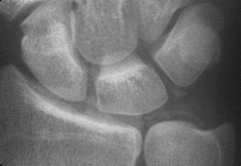Chondrocalcinosis In The Triangular Fibrocartilage Download
