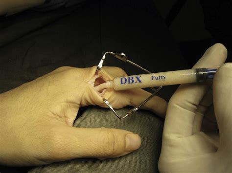 Application Of Synthes Dbx ® Putty Download Scientific Diagram