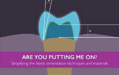 Are You Putting Me On Simplifying The Latest Cementation Techniques