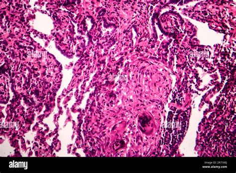 Caseous Pneumonia Light Micrograph Photo Under Microscope