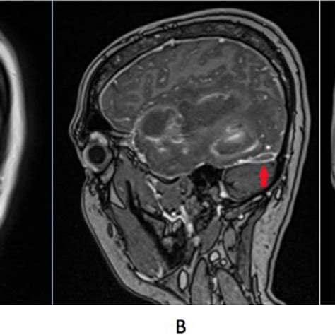 Showing Diffuse Swelling Over Right Side [arrow] Of His Neck